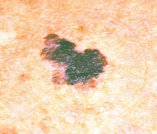 Checking Your Skin - Melanoma Institute Australia