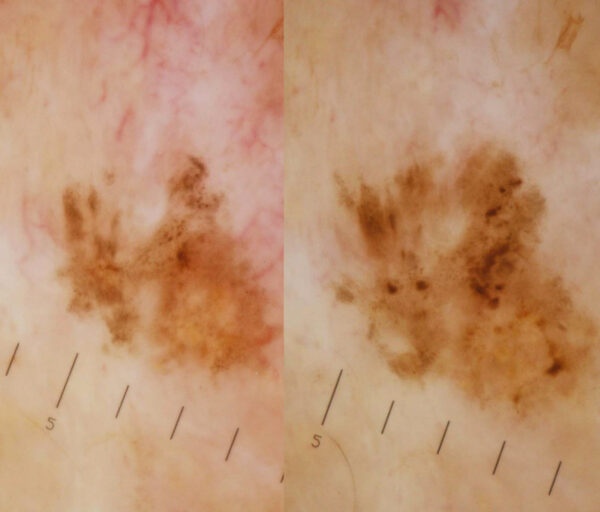 Checking Your Skin | Melanoma Institute Australia