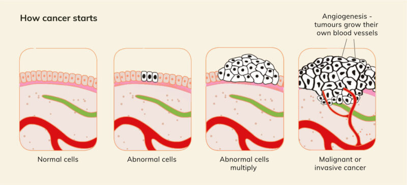What is Melanoma? | Melanoma Institute Australia