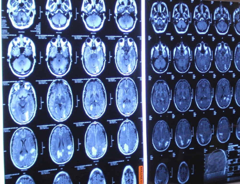 The Australian Melanoma Genome Project - Melanoma Institute Australia